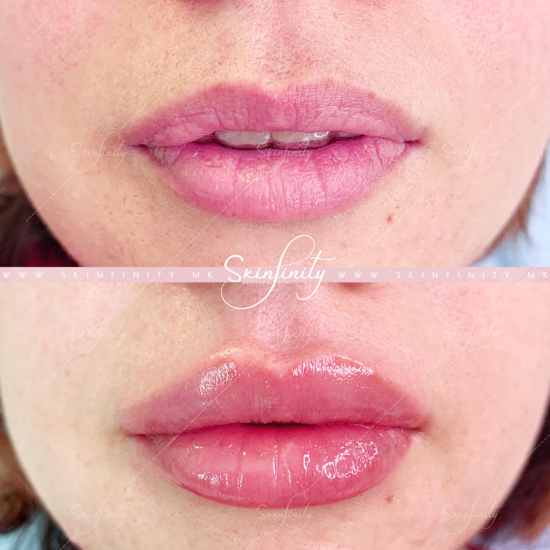 Филери | Dermal fillers | Fileri | Естетски третмани Skinfinity